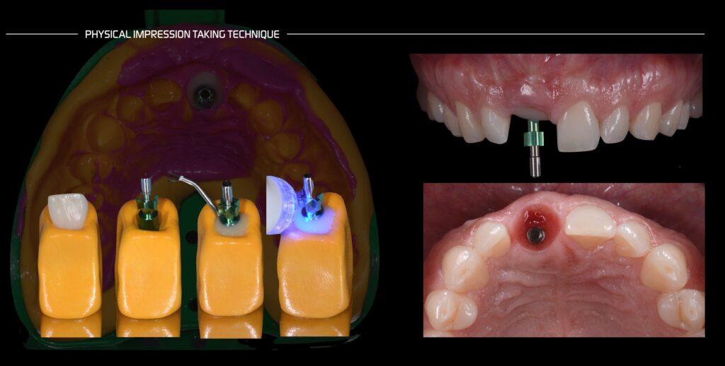 El uso de Provisionales sobre implantes. 3 Beneficios en el sector ...